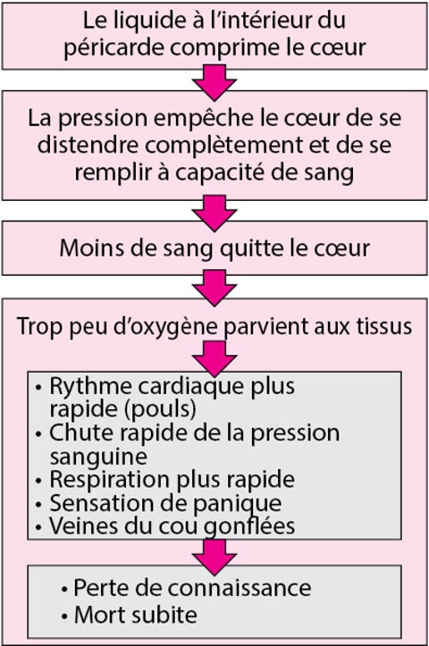 Image:Tamponnade cardiaque-Manuels Merck pour le grand public