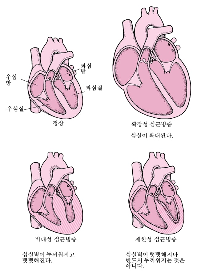 심근병증의 개요 심장 및 혈관 장애 Msd 매뉴얼 일반인용