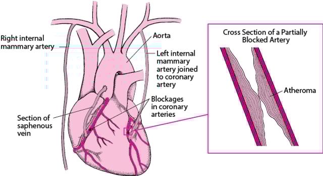 Image:Coronary Artery Bypass Grafting-MSD Manual Consumer Version