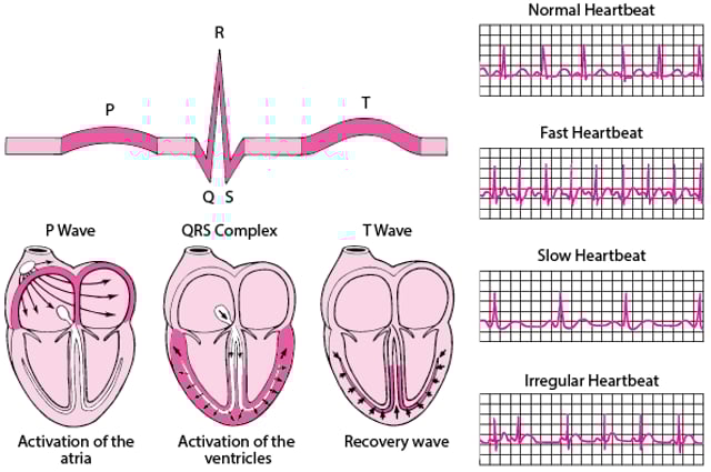 Atrial Premature Beats - Heart and Blood Vessel Disorders - MSD Manual ...