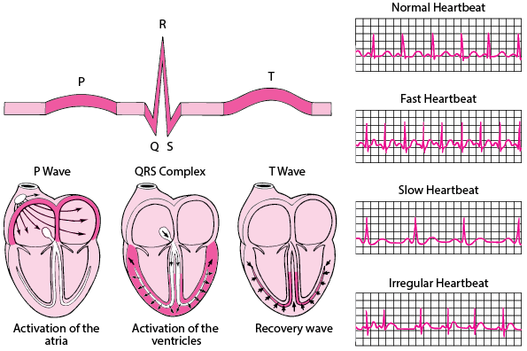 Atrial Fibrillation and Atrial Flutter - Heart and Blood Vessel ...