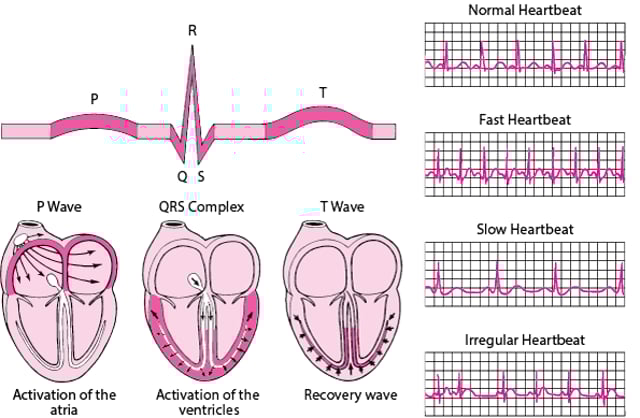 Présentation des troubles du rythme cardiaque - Troubles cardiaques et ...