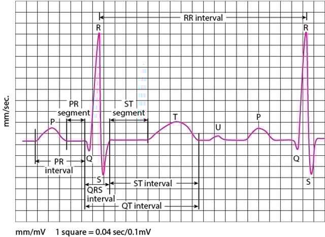 Long QT Interval Syndromes - Heart and Blood Vessel Disorders - MSD ...