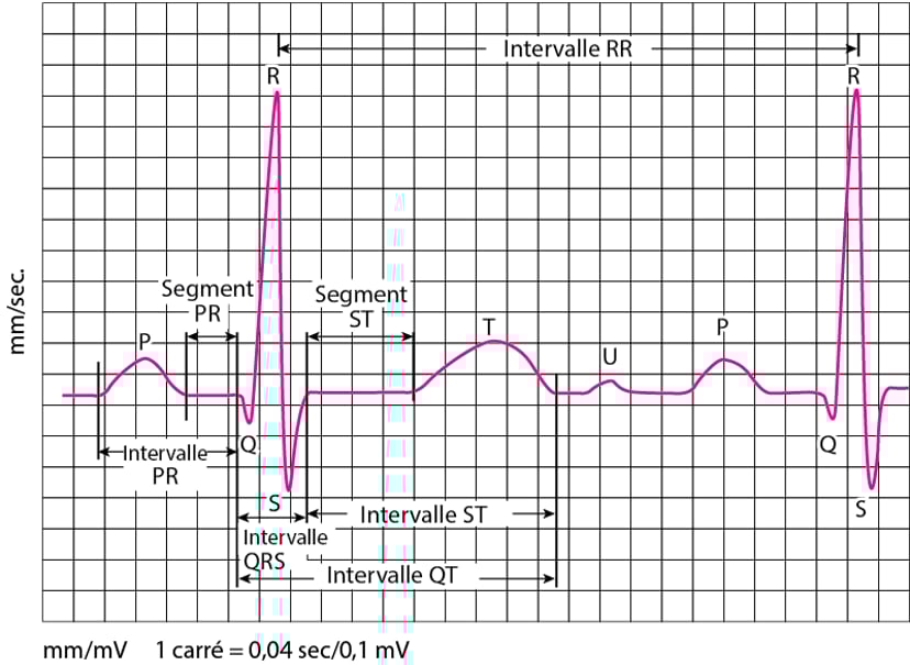 Syndromes de l’intervalle QT long - Syndromes de l’intervalle QT long - Manuels MSD pour le ...
