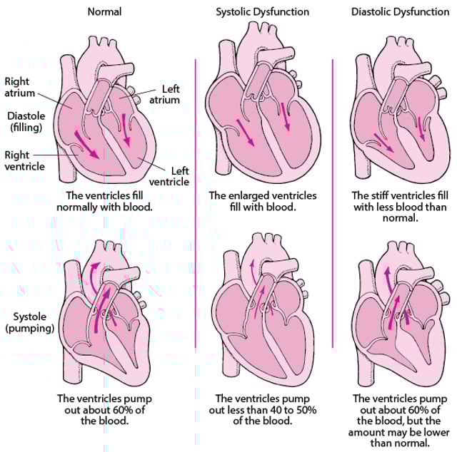 Heart Failure (HF) - Heart and Blood Vessel Disorders - MSD Manual ...
