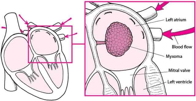 Myxomas - Heart and Blood Vessel Disorders - MSD Manual Consumer Version