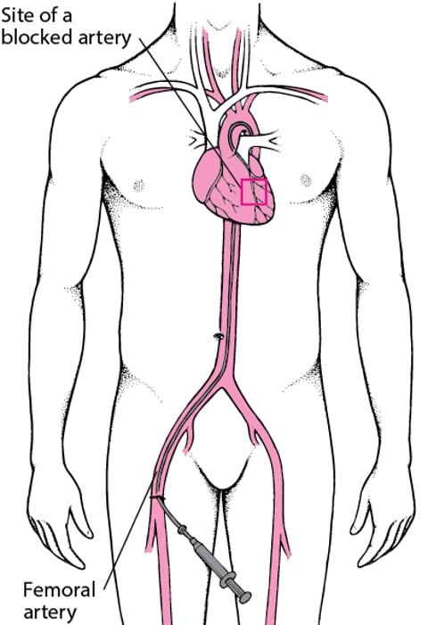 Image:Understanding Percutaneous Coronary Intervention (PCI)-Merck Manual Consumer Version