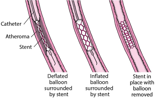 Image:Understanding Percutaneous Coronary Intervention (PCI)-MSD Manual ...