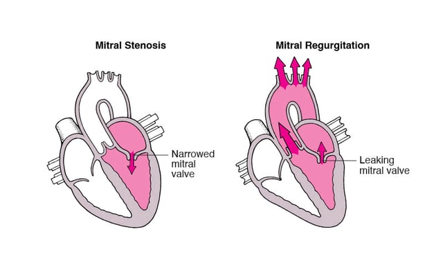 Overview of Heart Valve Disorders - Heart and Blood Vessel Disorders ...
