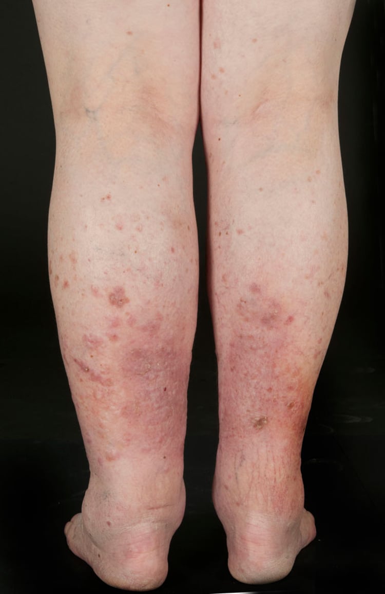 Squamous Cell Carcinoma in Situ - Cancer - MSD Manual Consumer Version