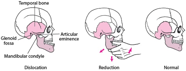 Jaw Dislocation - Mouth and Dental Disorders - MSD Manual Consumer Version