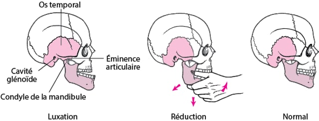Image:Repositionnement d’une luxation mandibulaire-Manuels MSD pour le ...