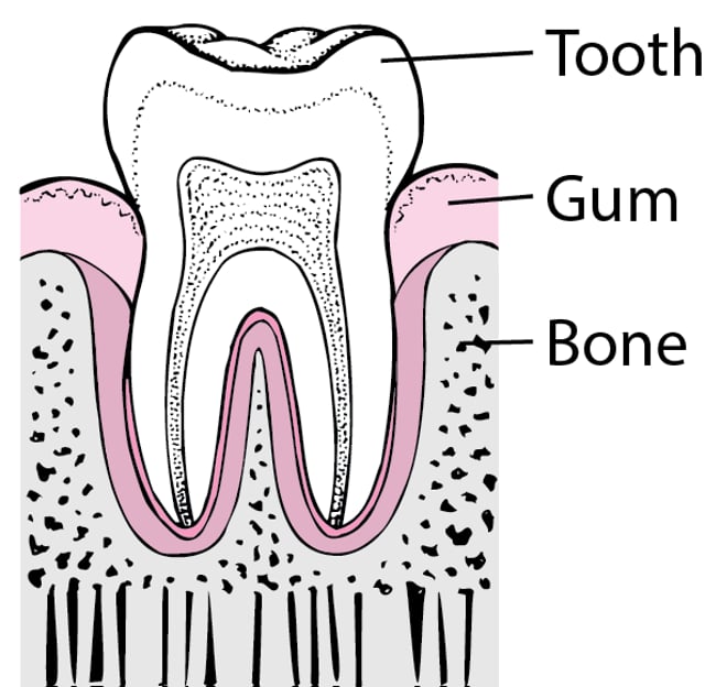 Periodontitis - Mouth and Dental Disorders - MSD Manual Consumer Version