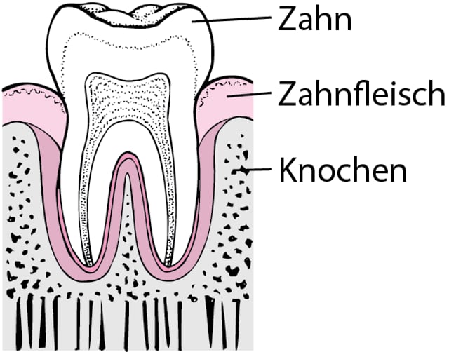 Parodontitis - Parodontitis - MSD Manual Ausgabe für Patienten