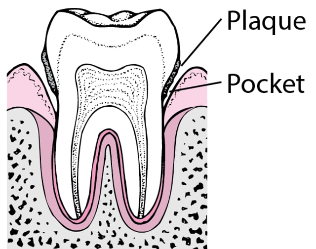 Periodontitis - Mouth and Dental Disorders - MSD Manual Consumer Version