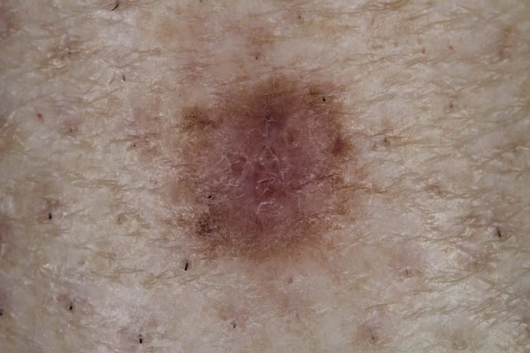 Dermatofibromas - Skin Disorders - Merck Manual Consumer Version