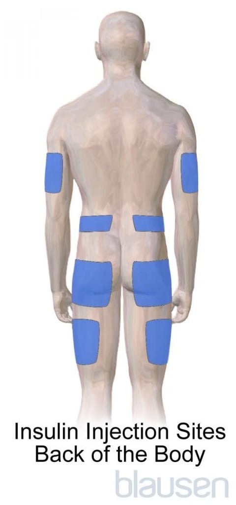 Pengobatan Diabetes Melitus - Gangguan Hormonal dan Metabolik - Manual ...