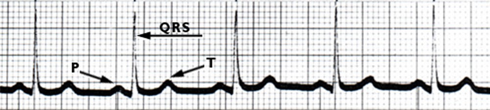 Quick Facts:Electrocardiography - Merck Manual Consumer Version