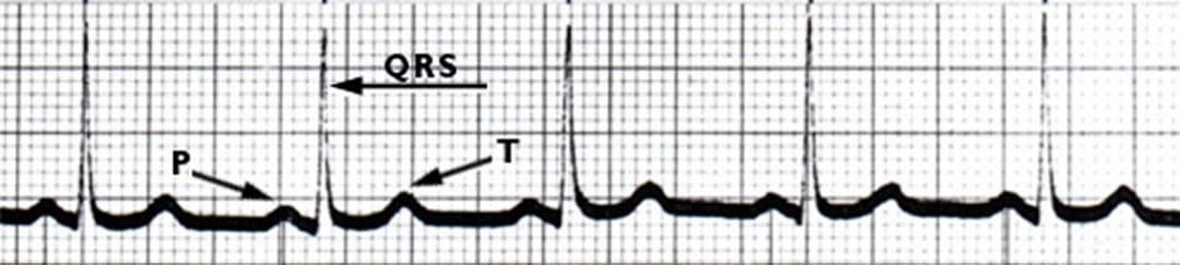 Électrocardiographie - Électrocardiographie - Manuels MSD pour le grand ...