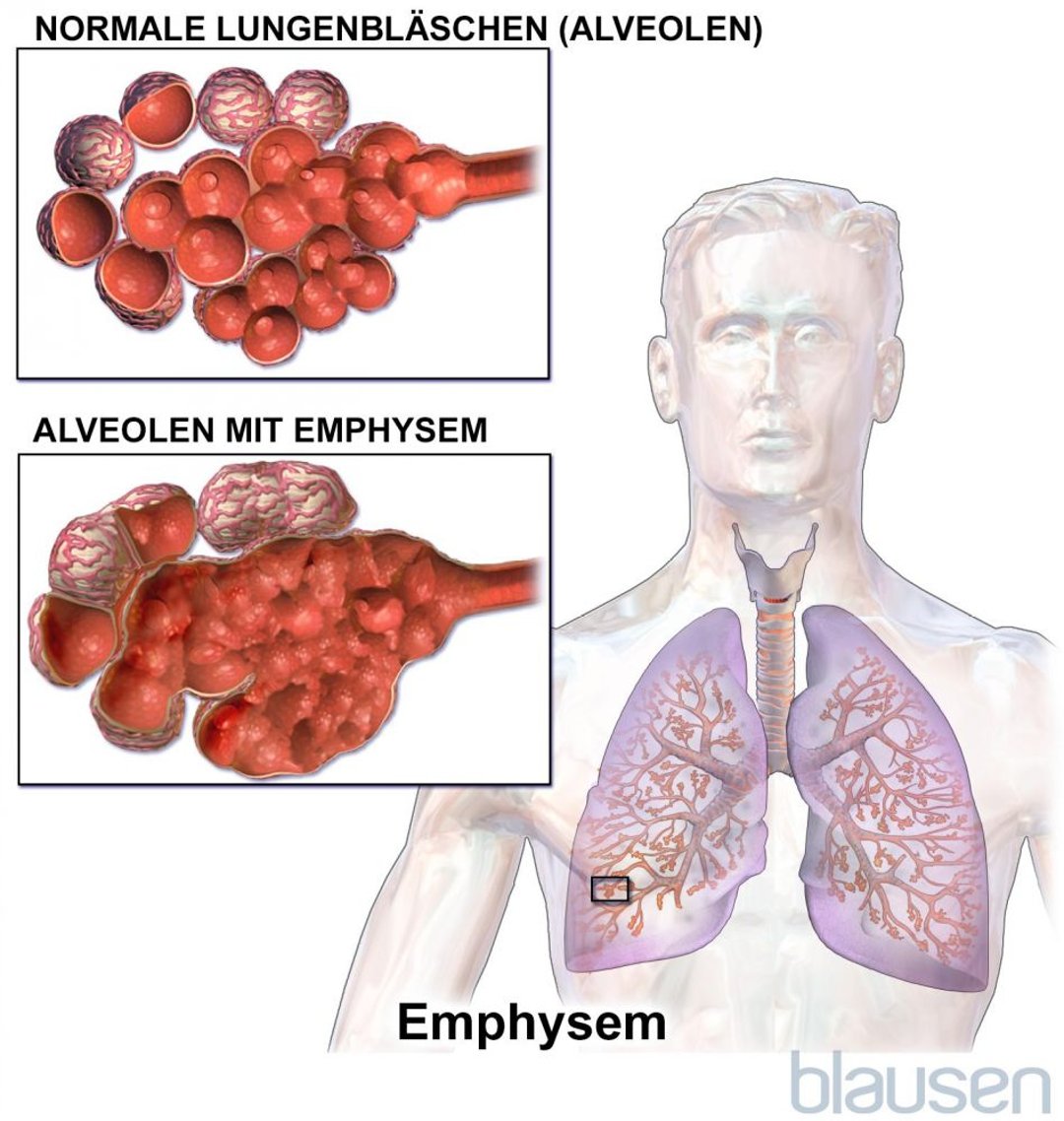 Chronisch obstruktive Lungenerkrankung (COPD) - Lungen- und ...