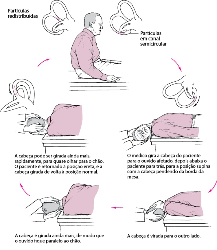 Image:Manobra de Epley: Um tratamento simples para uma causa comum de ...