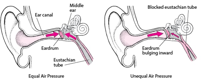 Barotrauma of the Ear - Ear, Nose, and Throat Disorders - MSD Manual ...
