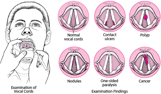 Image:Vocal Cord Problems-Merck Manual Consumer Version