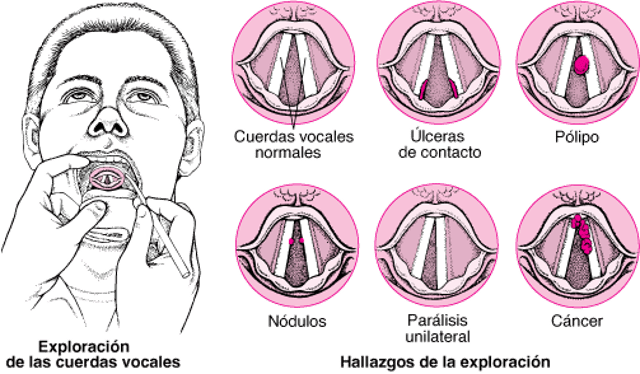 Image:Problemas en las cuerdas vocales-Manual MSD versión para público ...