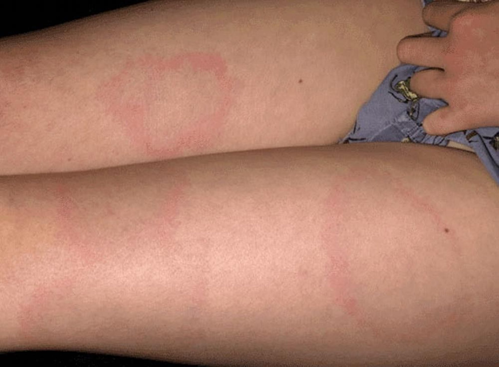 Image:The Rash of Lyme Disease (Erythema Migrans)-Merck Manual Consumer Version