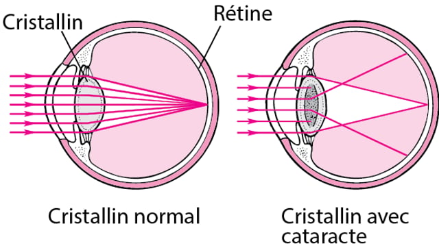 Cataracte - Troubles oculaires - Manuels MSD pour le grand public