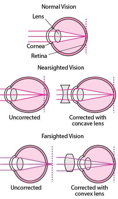 Overview of Refractive Disorders - Eye Disorders - MSD Manual Consumer ...