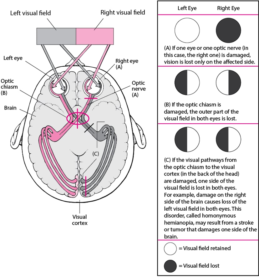 Image:Visual Pathways and the Consequences of Damage-MSD Manual ...