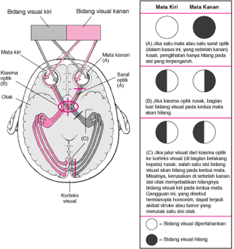 Gambaran Umum Tentang Gangguan Saraf Optik - Gangguan Mata - Manual MSD ...