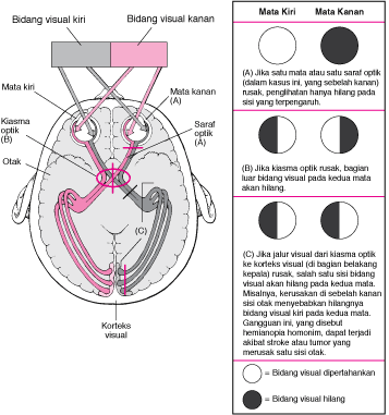 Gambaran Umum Tentang Gangguan Saraf Optik - Gangguan Mata - Manual MSD ...