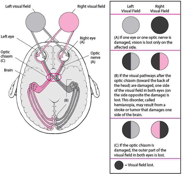 Image:When the Visual Pathways Are Damaged-MSD Manual Consumer Version