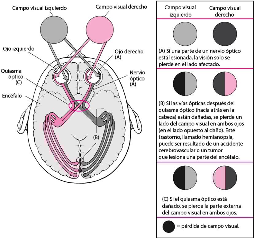 Pérdida repentina de la visión - Trastornos oftálmicos - Manuale Merck ...