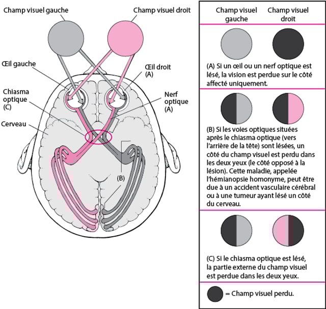 Perte de vision subite - Perte de vision subite - Manuels Merck pour le ...