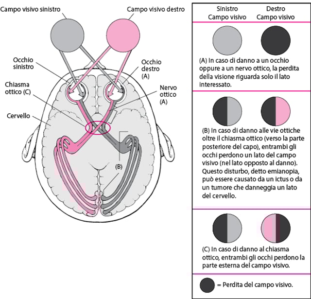 Perdita improvvisa della vista - Disturbi oculari - Manuale MSD ...
