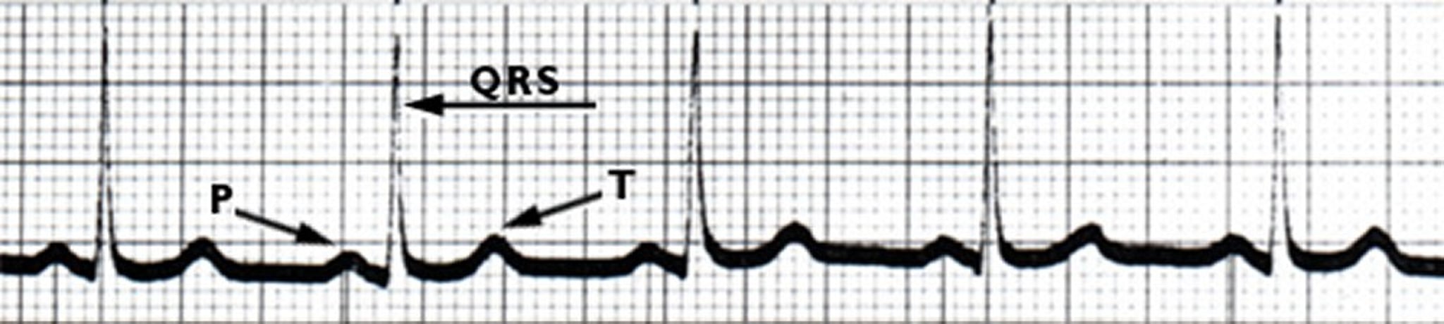 Image:EKG: Detak Jantung Normal-Manual MSD Versi Konsumen