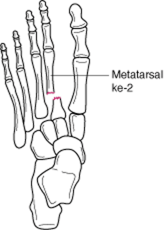 Fraktur Metatarsal - Cedera dan Keracunan - Manual MSD Versi Konsumen