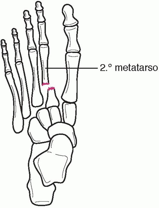 Fatos rápidos:Metatarso quebrado - Manual MSD Versão Saúde para a Família