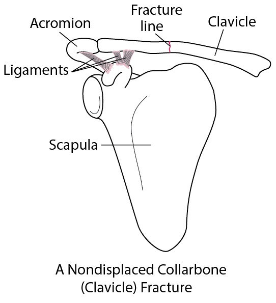 Collarbone Fractures - Injuries and Poisoning - MSD Manual Consumer Version
