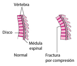 Fracturas vertebrales por compresión - Traumatismos y envenenamientos ...