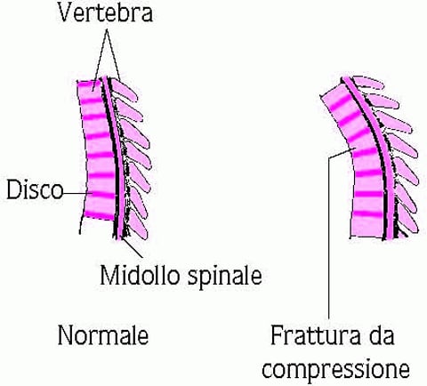Fratture da compressione della colonna vertebrale - Lesioni e ...