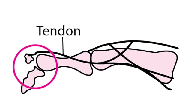 Quick Facts:Broken Fingertip - MSD Manual Consumer Version