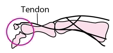 Fracturas de los dedos - Fracturas de los dedos - Manual MSD versión ...