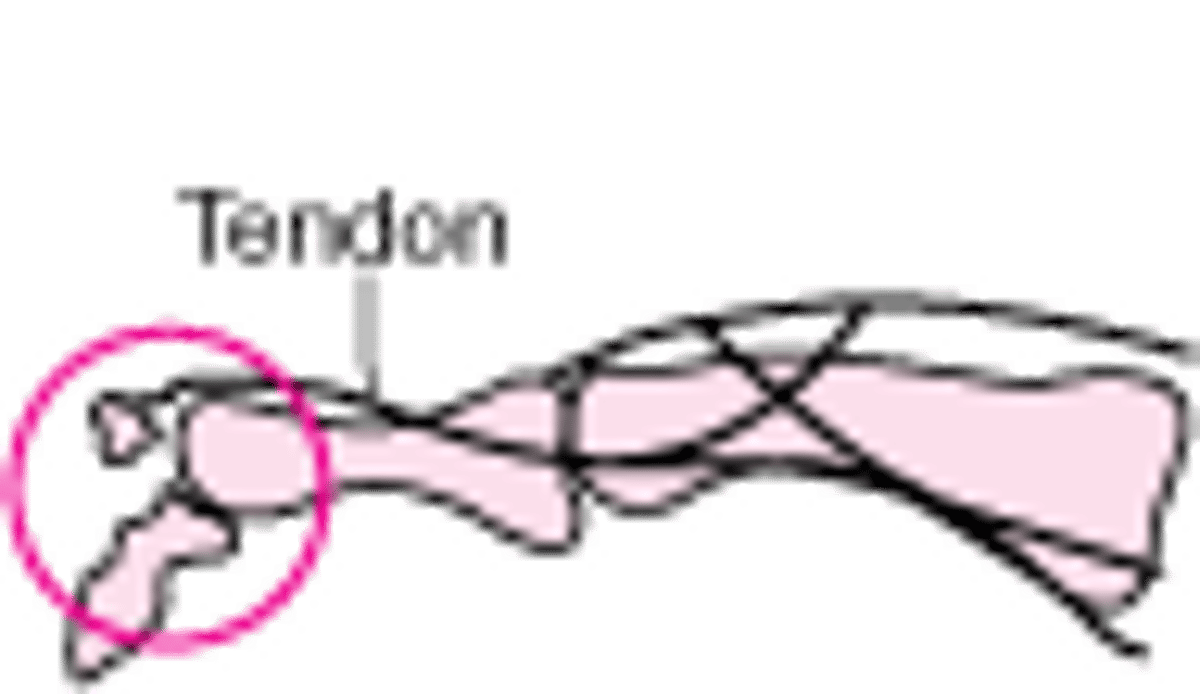 Fraktur Jari - Cedera dan Keracunan - Manual MSD Versi Konsumen