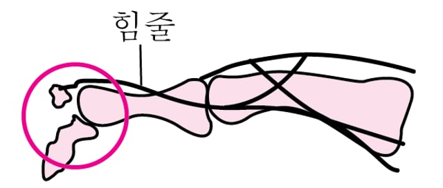 손가락 골절 부상 및 중독 Msd 매뉴얼 일반인용