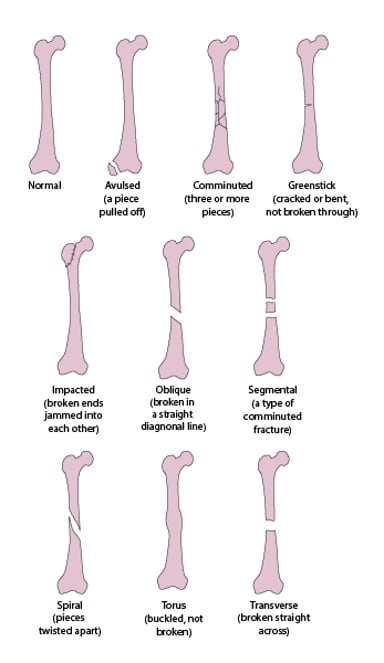 Image:Some Types of Fractures-MSD Manual Consumer Version