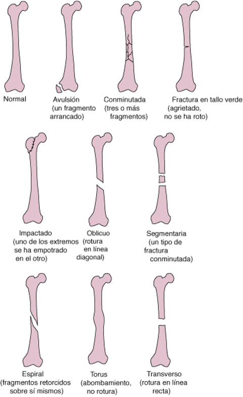 Image:Algunos tipos de fracturas-Manual MSD versión para público general